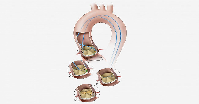 Phương pháp mới giúp thay thế van tim an toàn hơn - KhoaHoc.tv