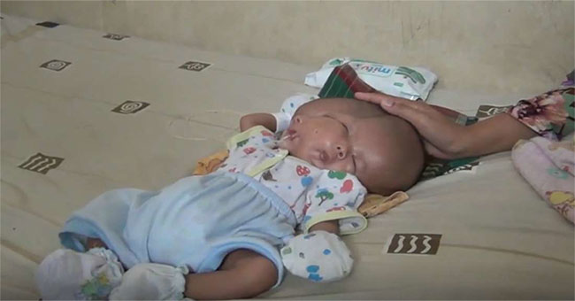 Bé trai Indonesia mắc dị tật hiếm gặp nhất: sinh ra với 2 khuôn mặt và ...